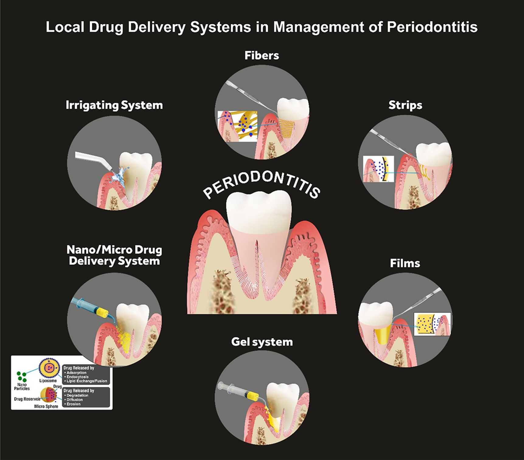 Local Delivery and Controlled Release Drug Systems in Periodontal Diseases